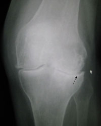 Introduction to Osteoarthritis (OA) of the Knee - Physical Therapy Web