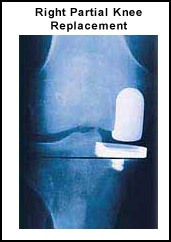 Partial Knee Replacement Surgery - Physical Therapy Web